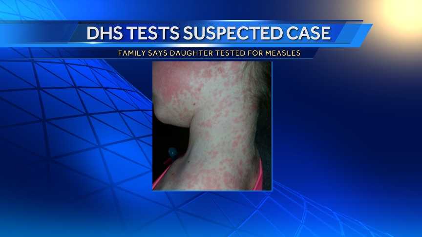 Results from one measles test are negative, Greenwood family says