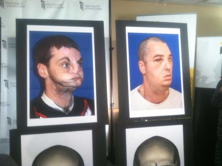 Photos: Docs Show Successful Face Transplant