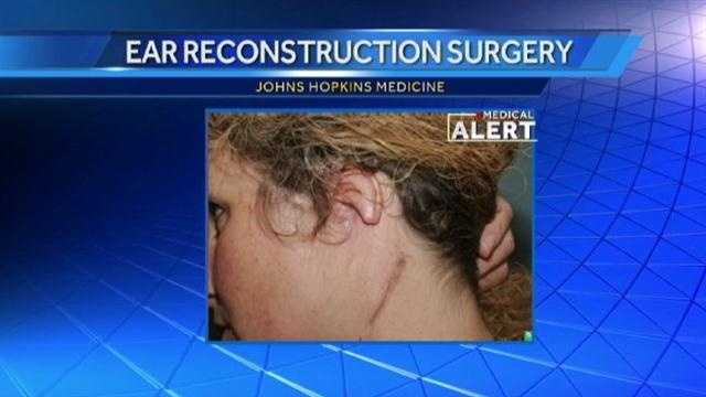 In photos: Surgeons successfully rebuild ear