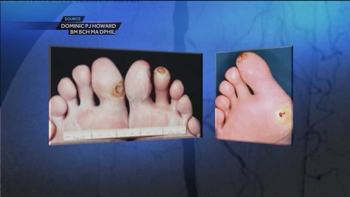 Blood vessels narrow in peripheral artery disease