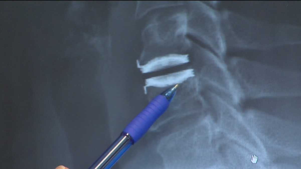 Surgery helps fix disc, nerve problems in neck