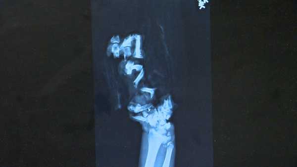 Expert explains damage fireworks can do to hand