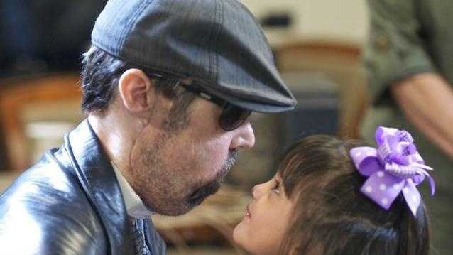 Photos: First Full Face Transplant 1 Year Later