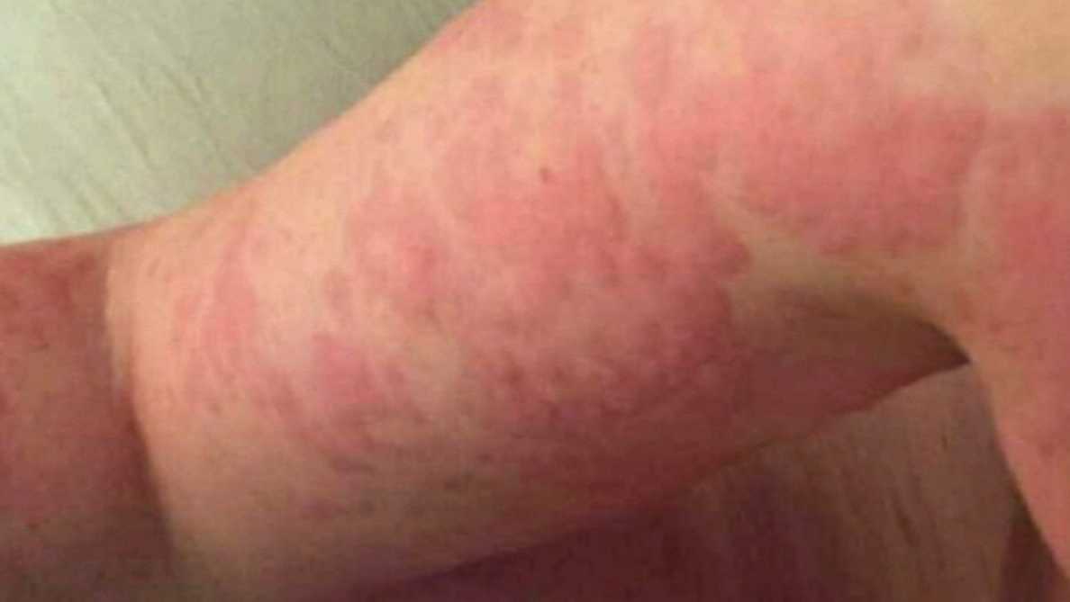 'I'm allergic to myself:' Woman allergic to own sweat, tears
