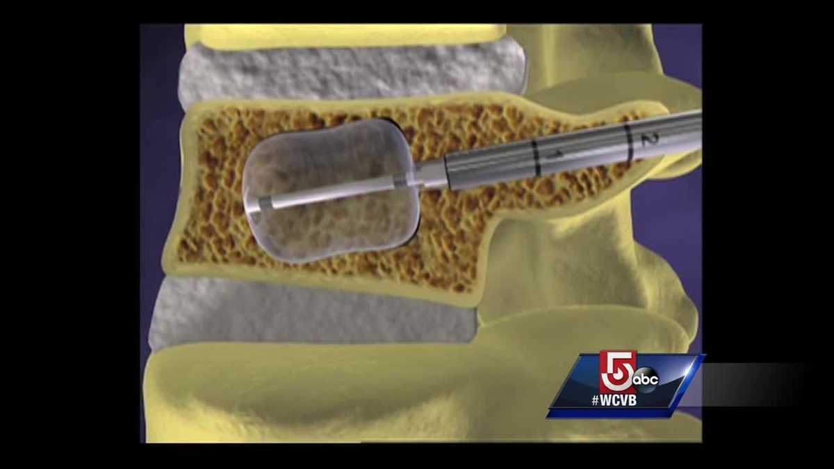 Outpatient 'balloon procedure' offers low-risk repair for fractured backs