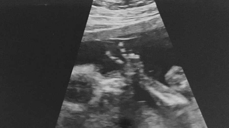 Unborn baby girl gives peace sign during ultrasound