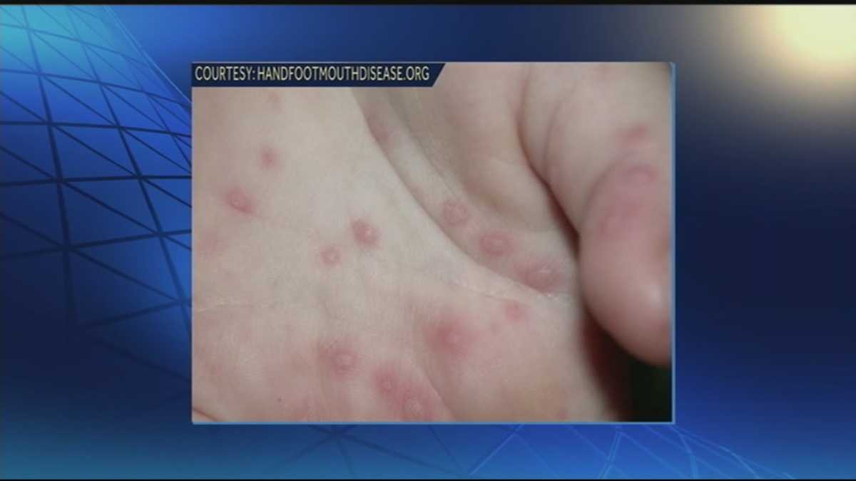 Highly contagious illness on rise in Susquehanna Valley