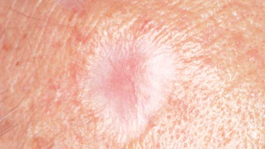 Skin cancer: what you need to know