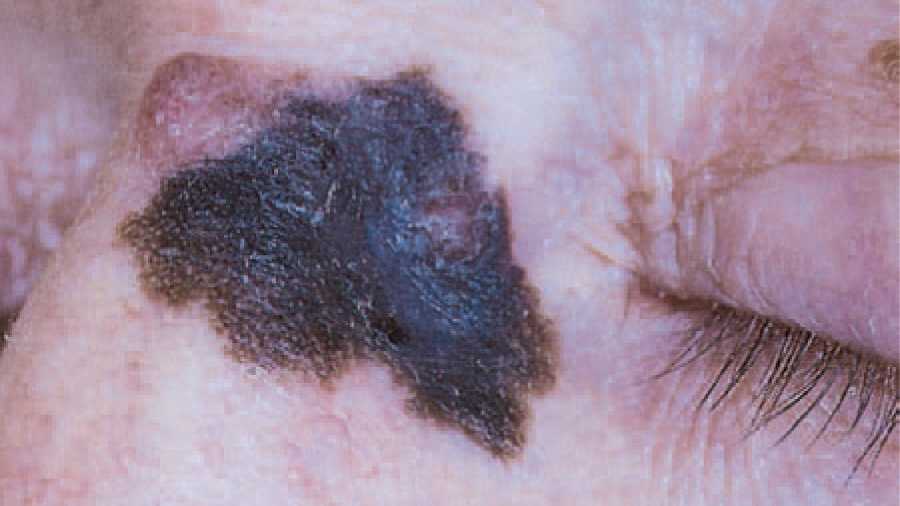 Skin cancer: what you need to know