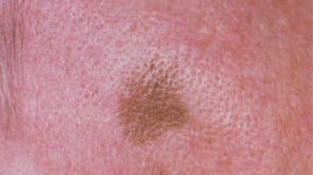 Skin cancer: what you need to know