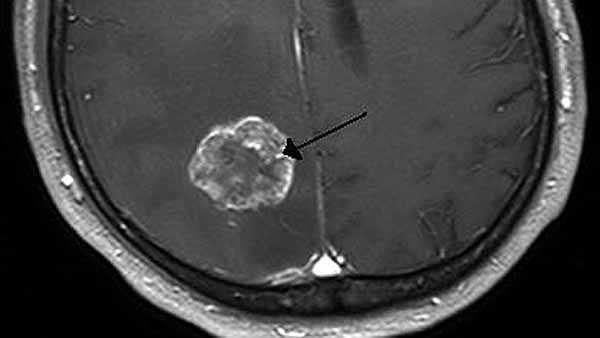 UC researchers learn more about how cancer spreads to brain