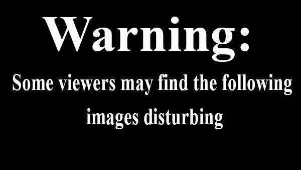 Facts about Krokodil, the "flesh-eating drug"