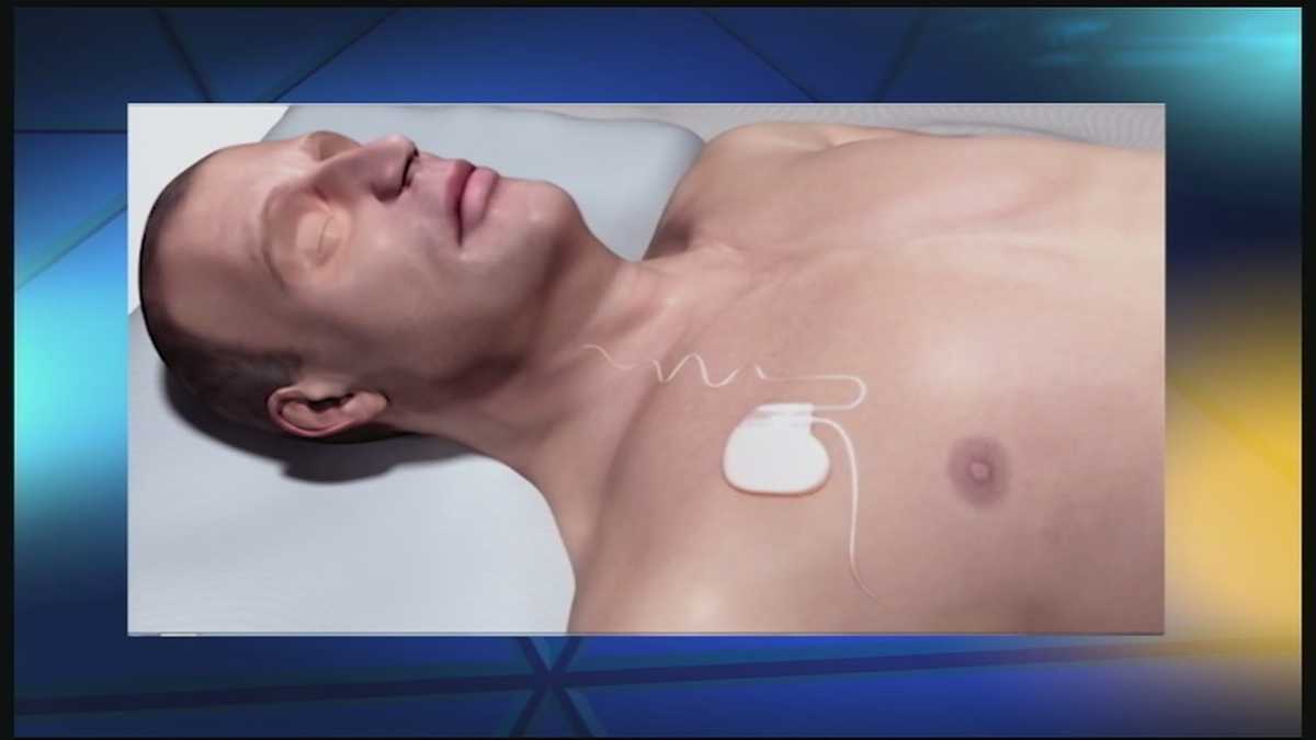 UC Health to use new FDA-approved technology for sleep apnea