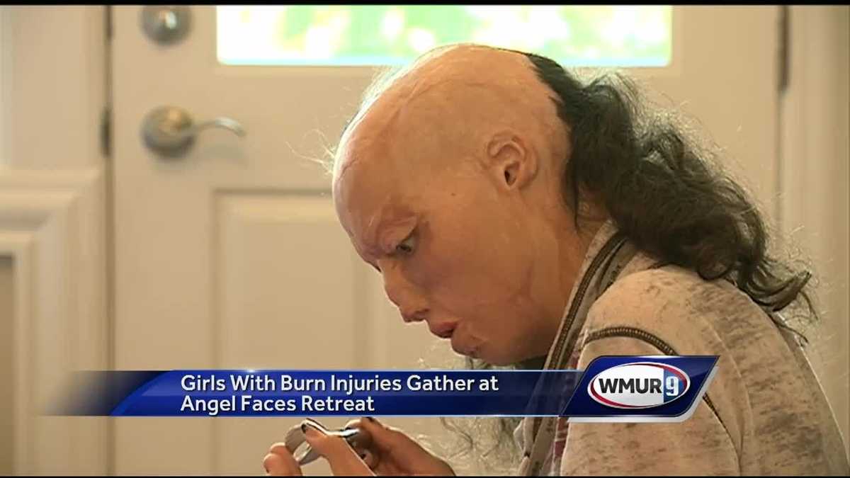 For girls affected with burn and trauma injuries, 'Angel Faces' offers ...