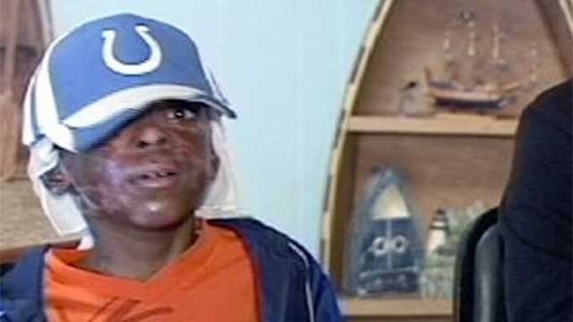 Boy burned in house fire returns after emergency operation out of state