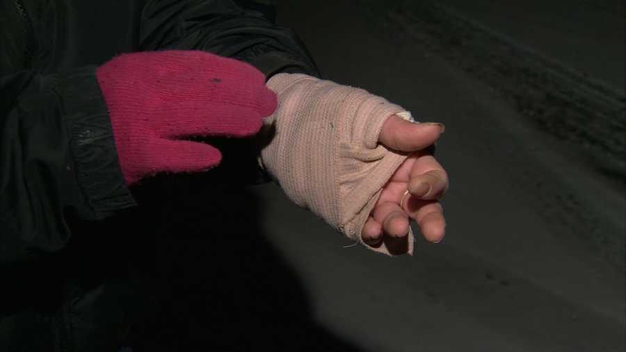 Photos: Monroeville woman bitten in raccoon attack