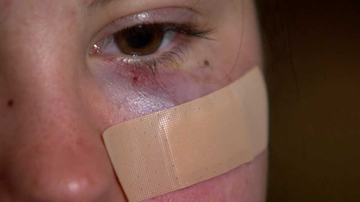 13-year-old walking home from school shot in face with BB gun, police say