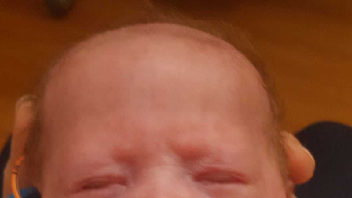 IMAGES: Louisville baby with rare condition travels country for treatment