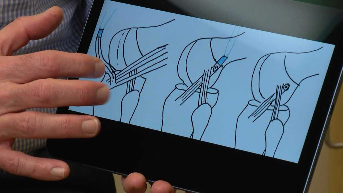 New procedure helps repair torn ACL