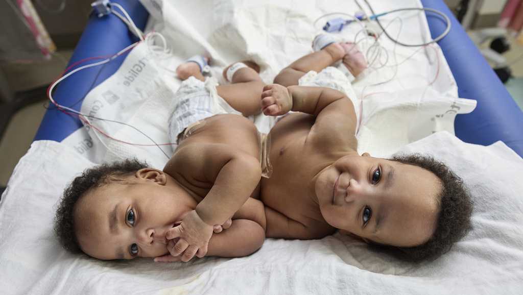 Twin boys celebrate first birthday after life-changing surgery