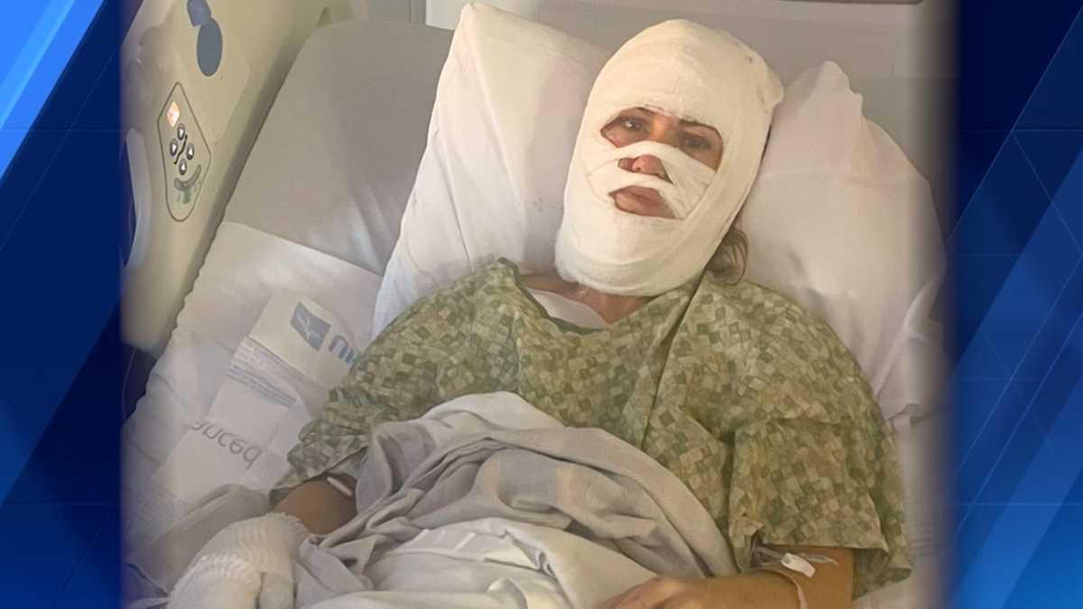 Experts say recovery will be long for Savannah acid attack victim
