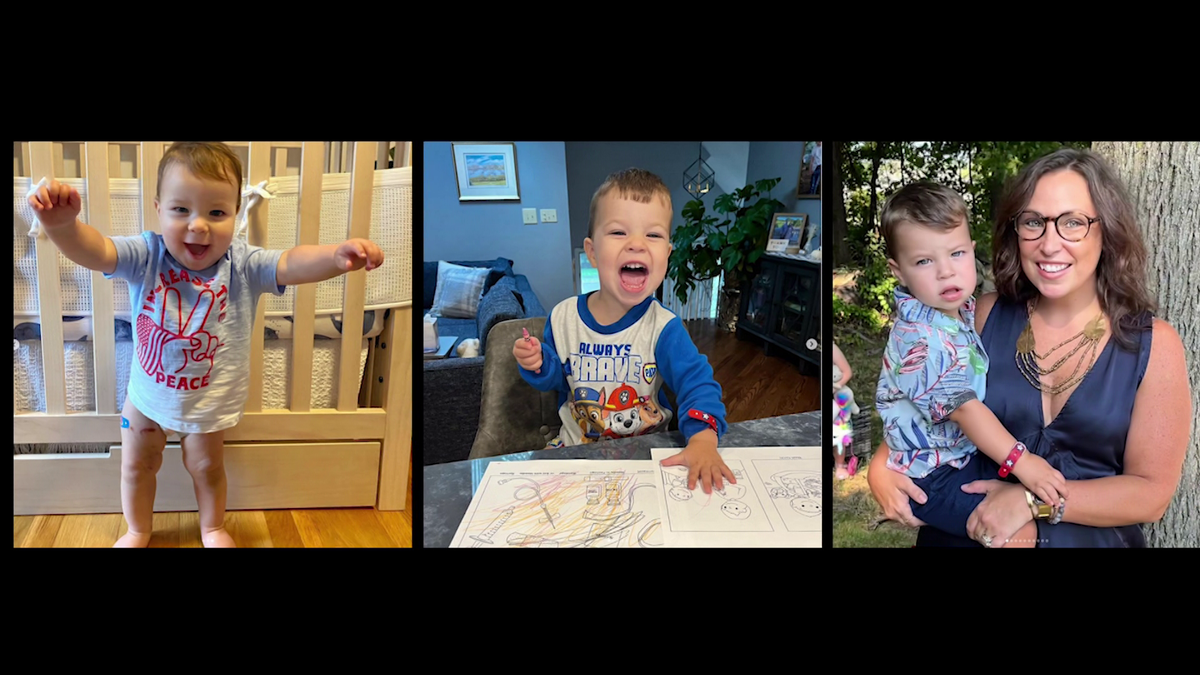 Mystery bruises reveal rare genetic condition for Massachusetts toddler