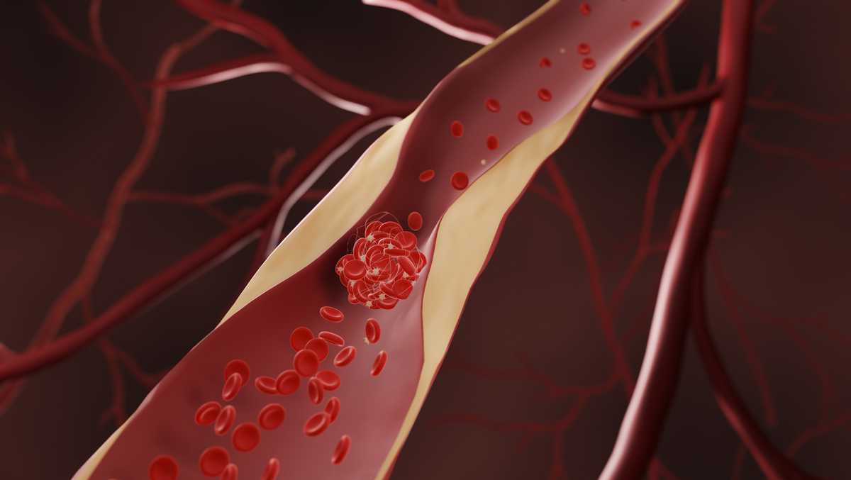 What are blood clots and symptoms to look out for
