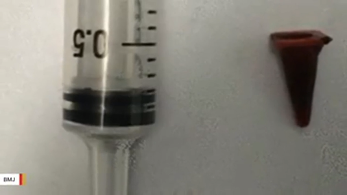 Suspected tumor turns out to be toy inhaled by man 40 years ago