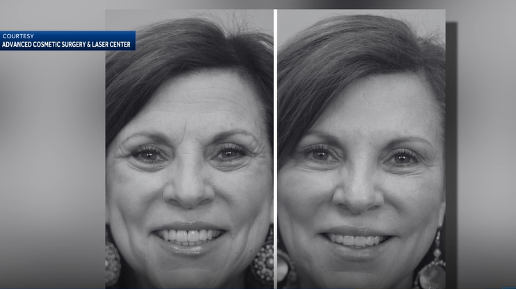 'Barbie Botox': Local plastic surgeon talks about new cosmetic trend