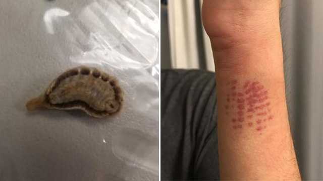 Teen rushed to hospital after encounter with venomous caterpillar