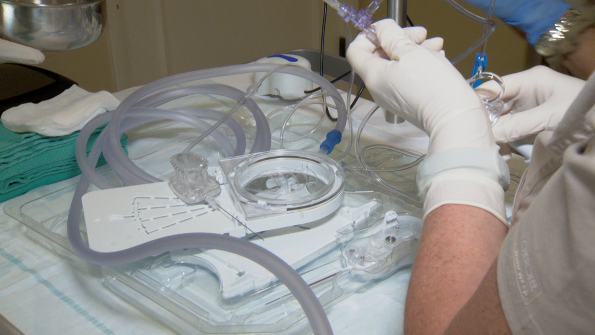 Orlando-area surgeons offering procedure that could permanently get rid ...