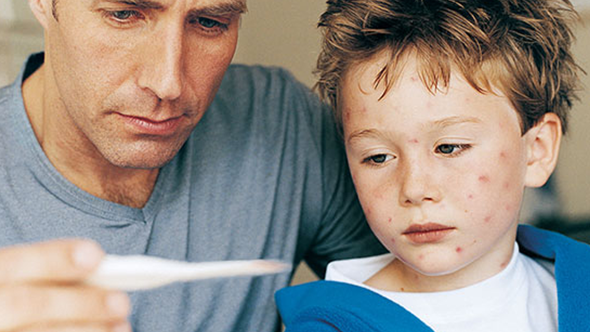 Buncombe County sees rise in chickenpox cases