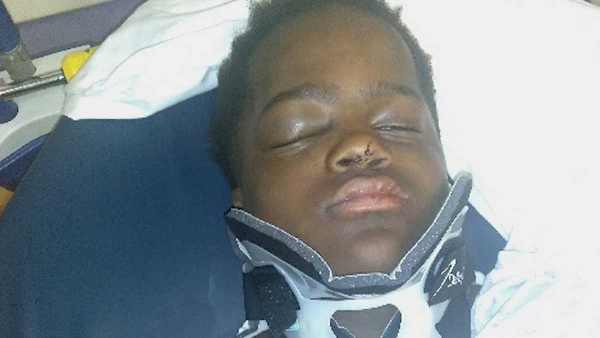 Student has head, facial injuries after fall from school balcony