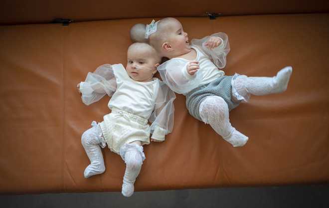 Previously conjoined Sacramento twins are home in time for Christmas