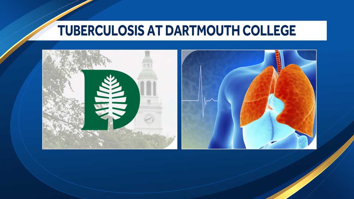 Tuberculosis case at Dartmouth College: Patient is in isolation