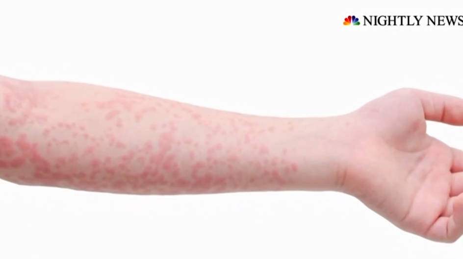 Florida measles: Officials confirm more cases at elementary school