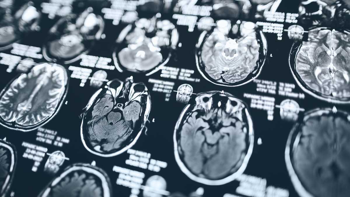 What to know about football brain trauma and CTE