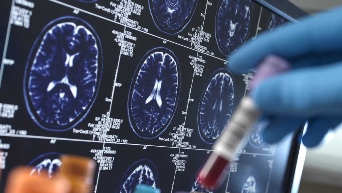 Boca Raton doctor explains new FDA-approved Alzheimer’s treatment