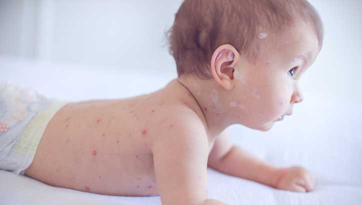 Should those who get chickenpox share it?