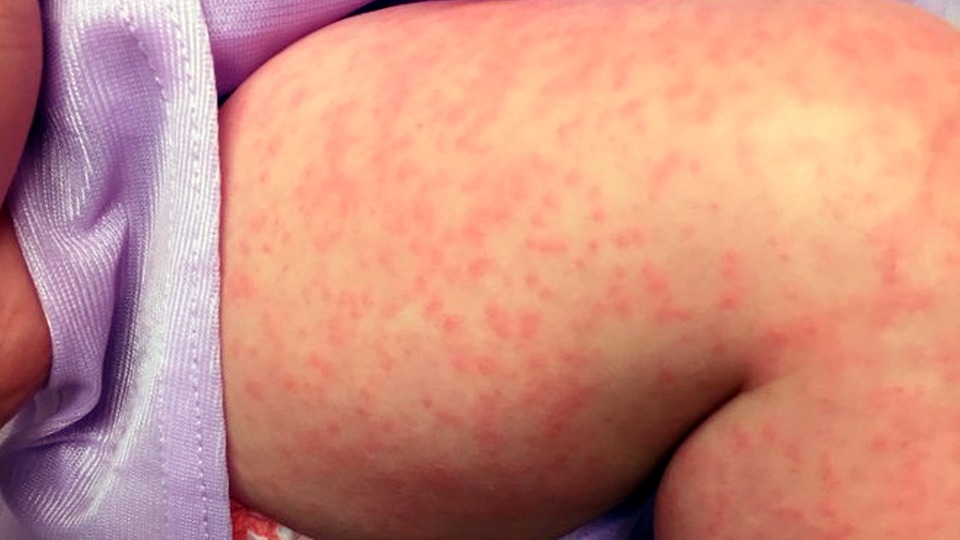 Alabama baby tests positive for measles Alabama baby tests positive for measles
