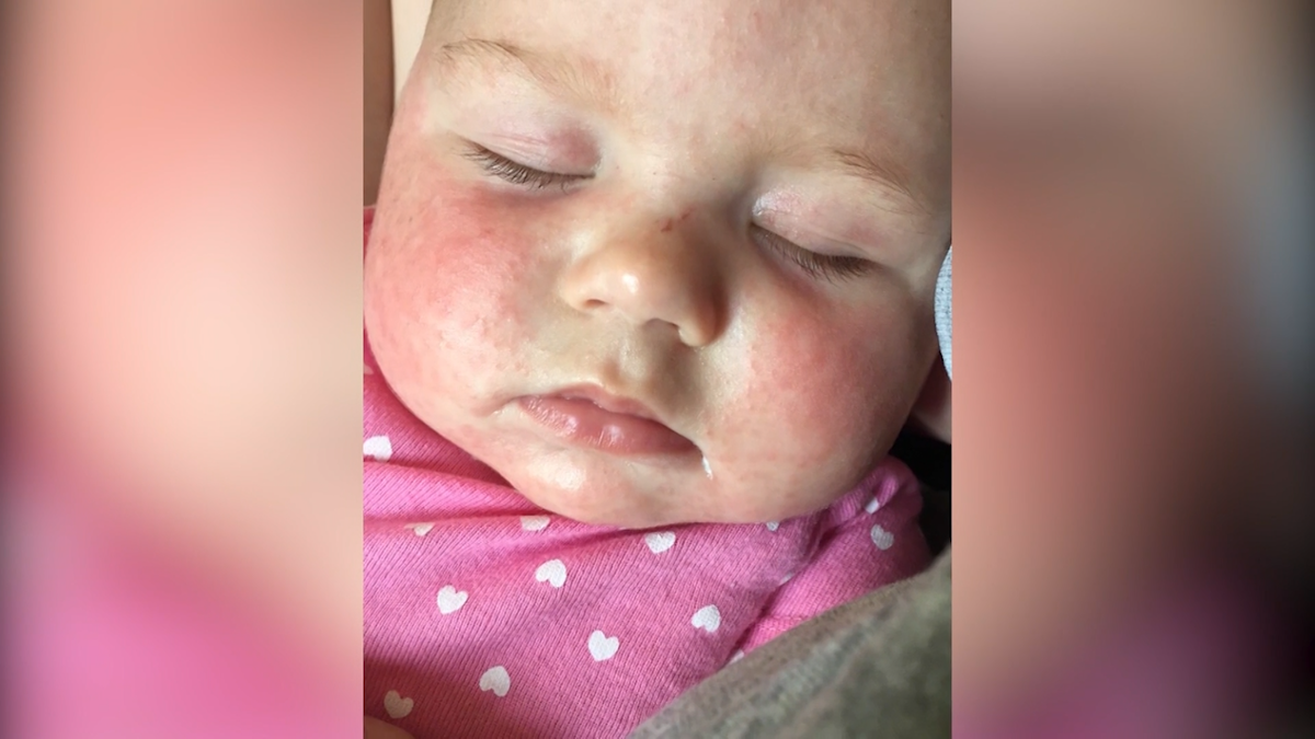ADPH: CDC measles test results negative for Pell City baby