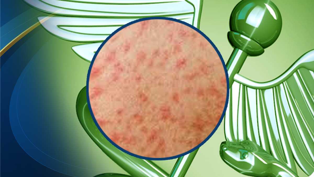 Maine measles case under investigation by state's CDC