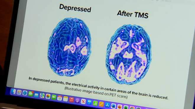 This treatment can help treat depression by waking up brain cells