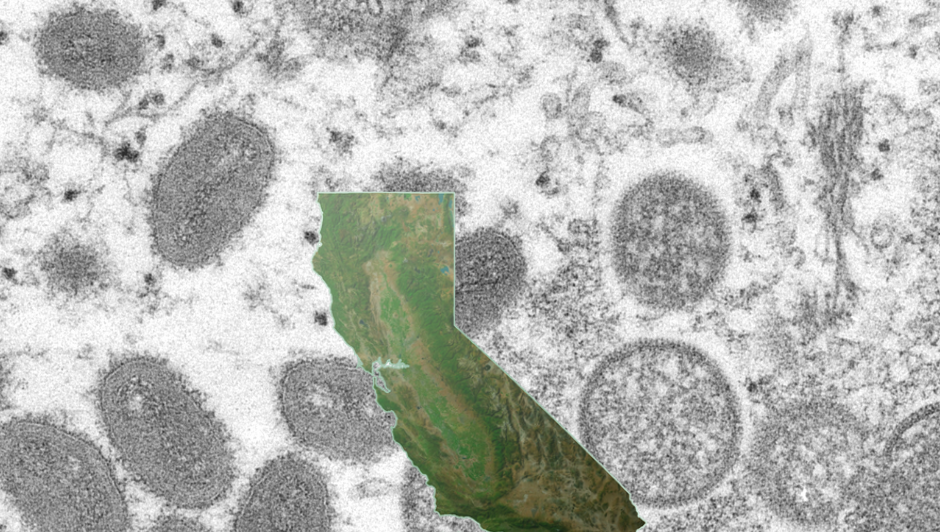 First US case of new severe mpox strain found in Bay Area