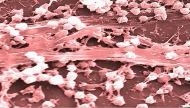 What is MRSA, and how do you know if you have it?