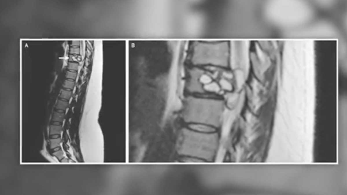 Woman's tingling legs turned out to be parasite in her back