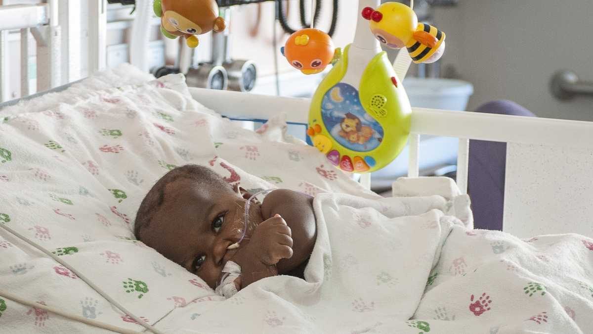 Surgeons remove parasitic twin from girl born with four legs