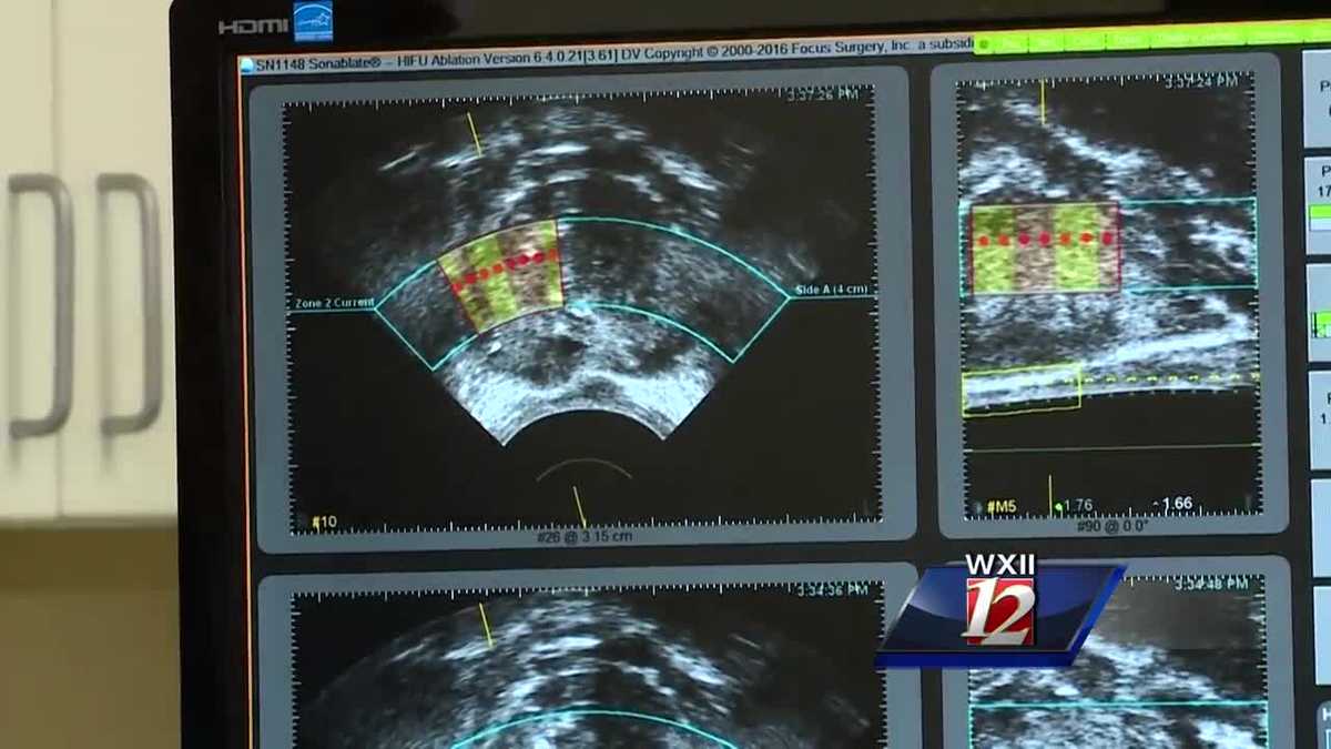 New medical procedure helps fight prostate cancer