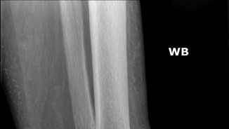 Total ankle replacement surgery offers pain relief for Boston patients