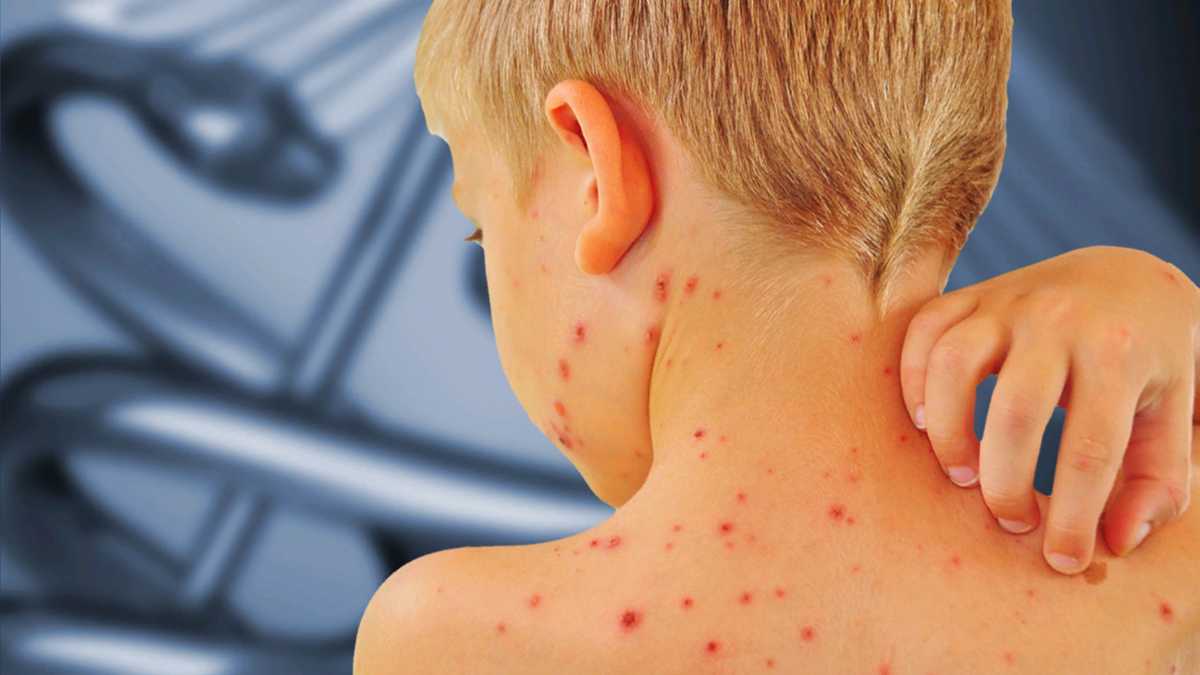 Chicken Pox outbreaks reported across South Carolina